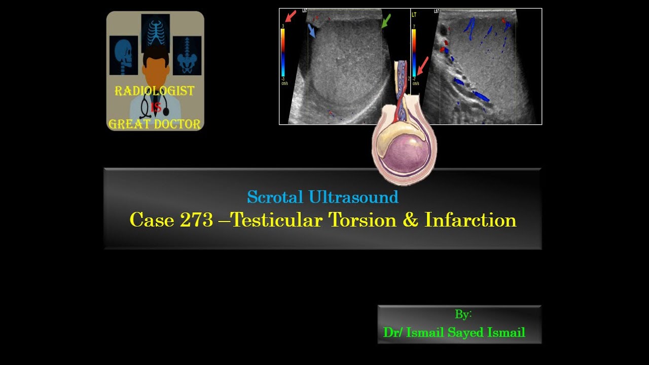Ultrasound Case 273 - Acute Testicular Torsion - YouTube
