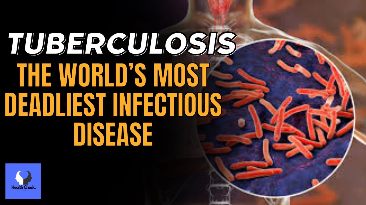 TUBERCULOSIS(TB): TB kills More people Than Malaria And HIV combined ...