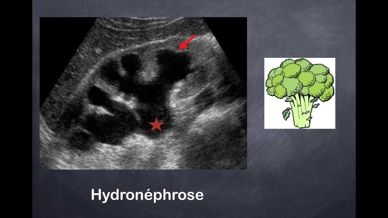 Infections urinaires - 2. Pyélonéphrite aiguë - échographie - YouTube