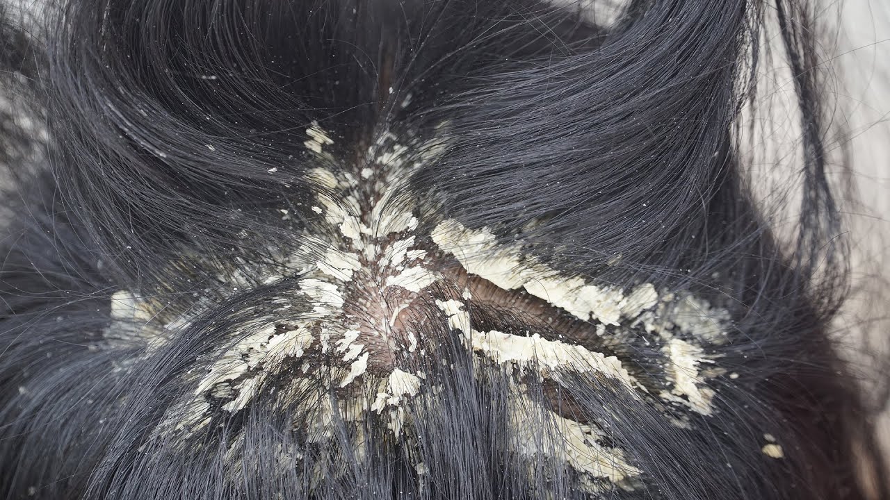 Deep Scalp Scratch Reveals a Massive Hidden Flake Layer #499 - YouTube