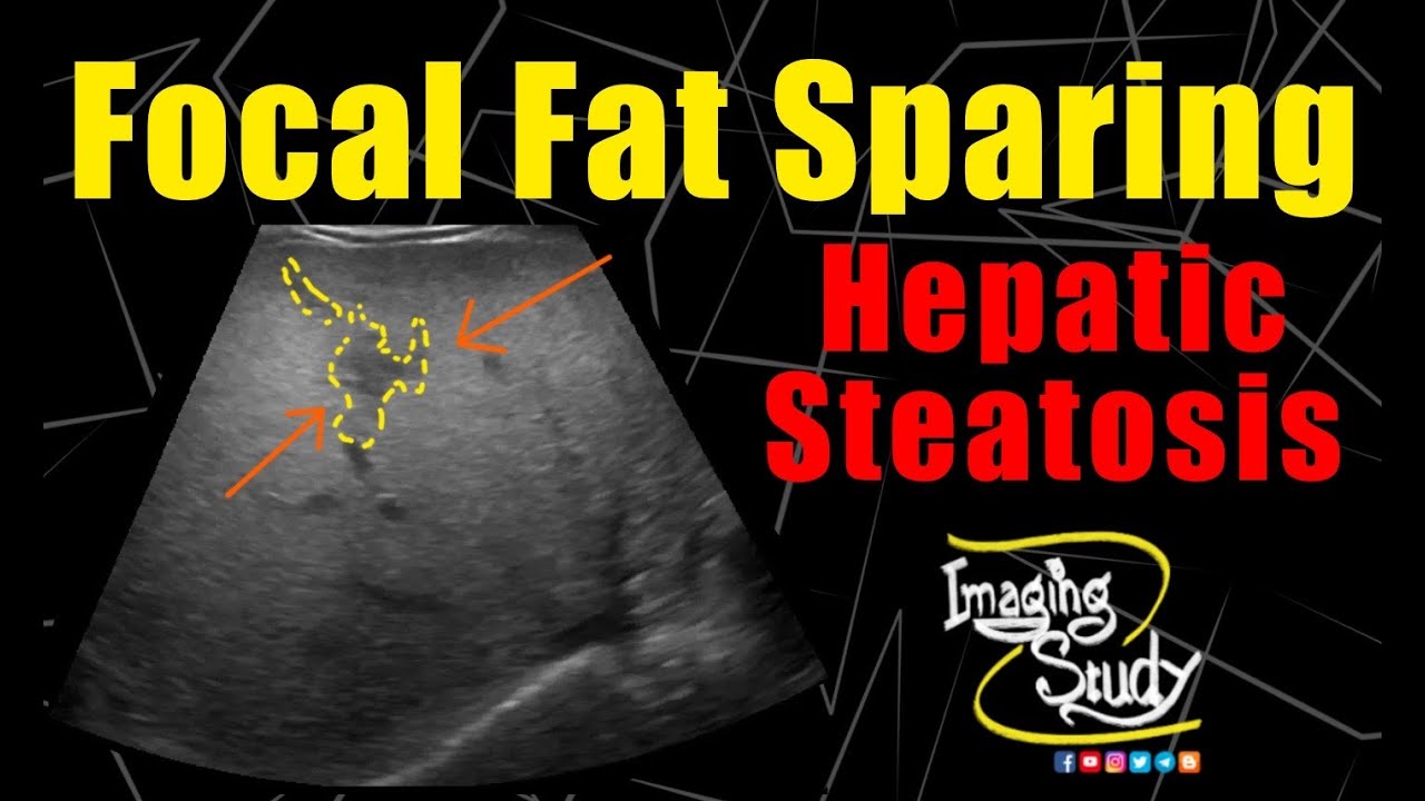 Hepatic Focal Fat Sparing Ultrasound Case 173 Youtube