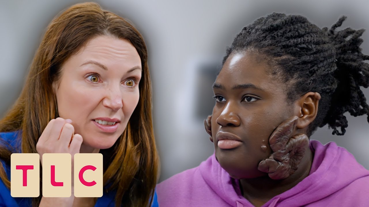 Dr. Emma Treats Patient With MASSIVE Keloids On Her Face! | The Bad ...