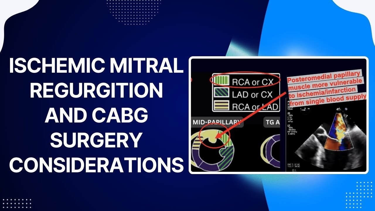 Ischemic Mitral Regurgitation: CABG Alone or Valve Repair ...