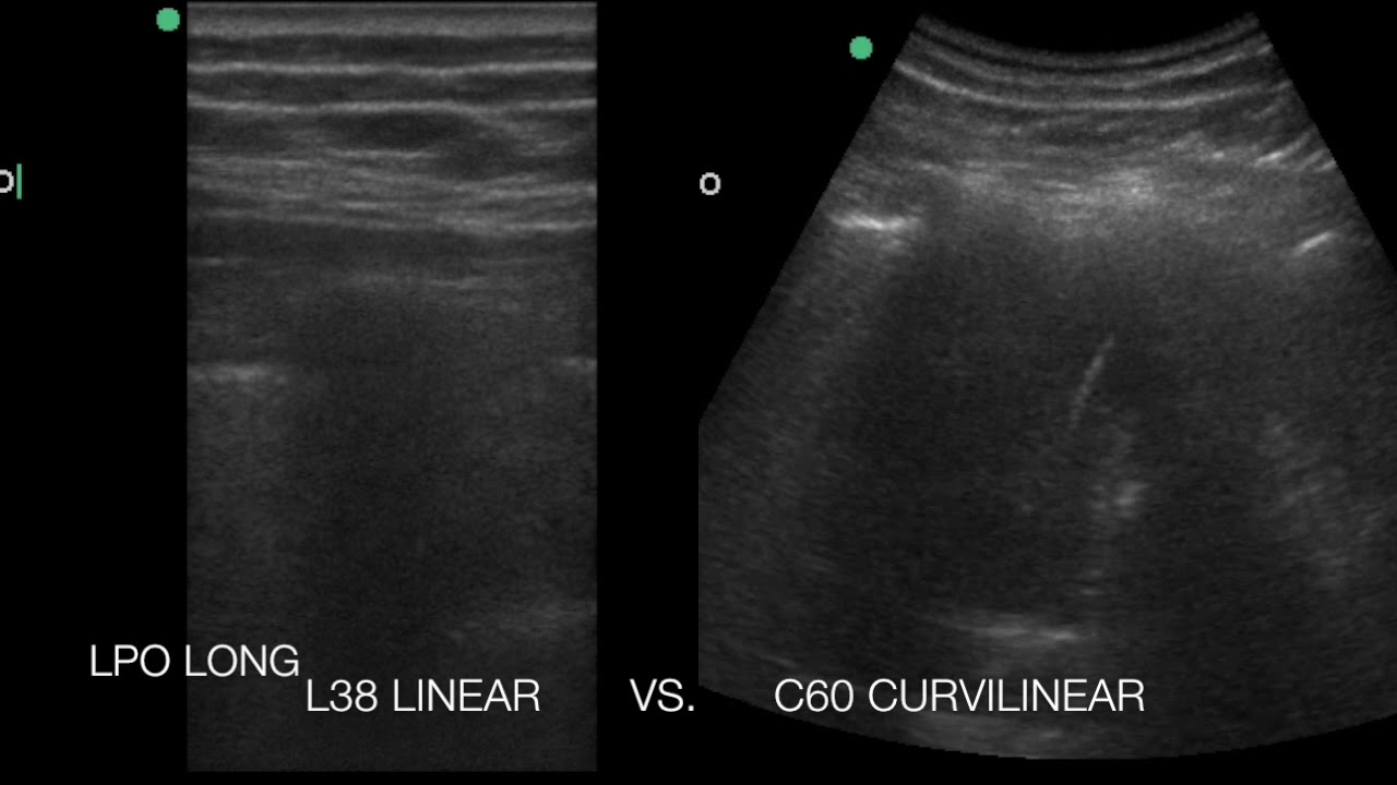 Linear Vs. Curvilinear Lung Consolidation with Air Bronchograms in ...