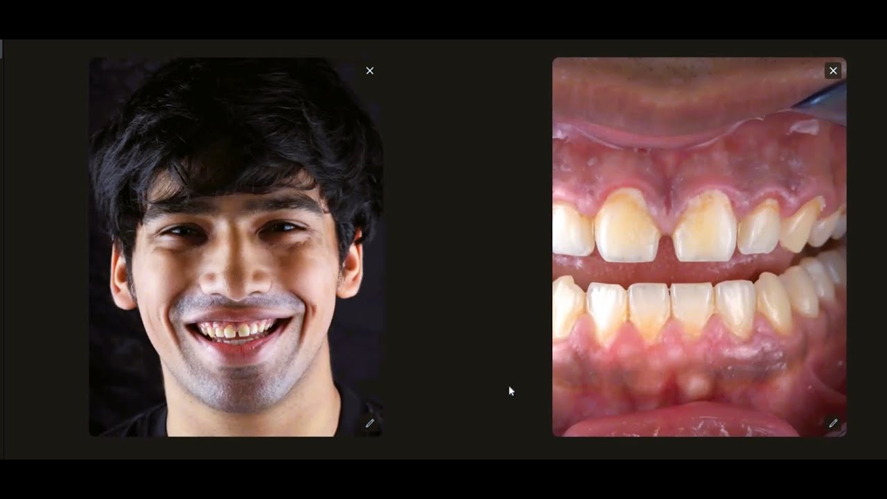 How to Upload Retracted Images in DTS PRO | Smile Design Tutorial - YouTube
