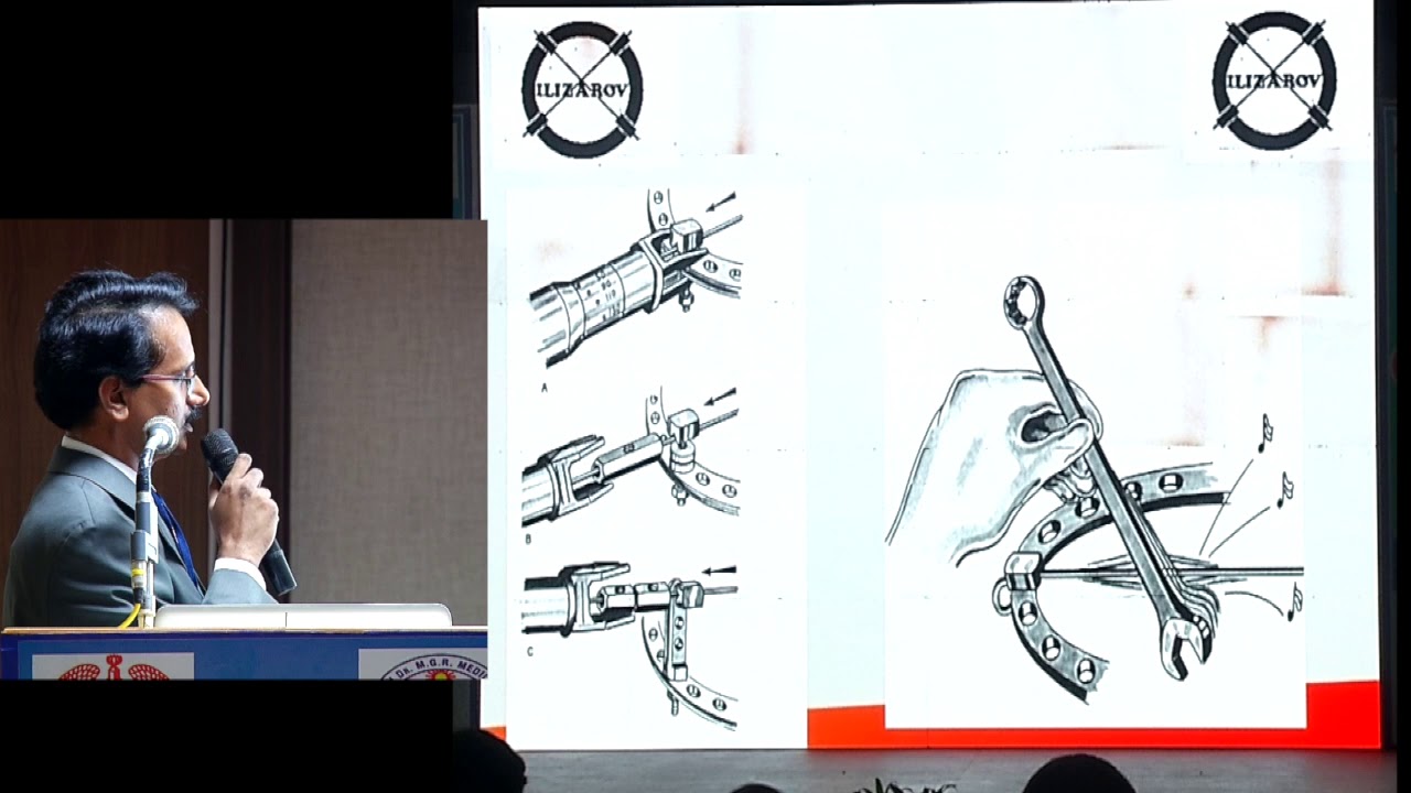 Surgical Technique Of Ilizarov system - YouTube