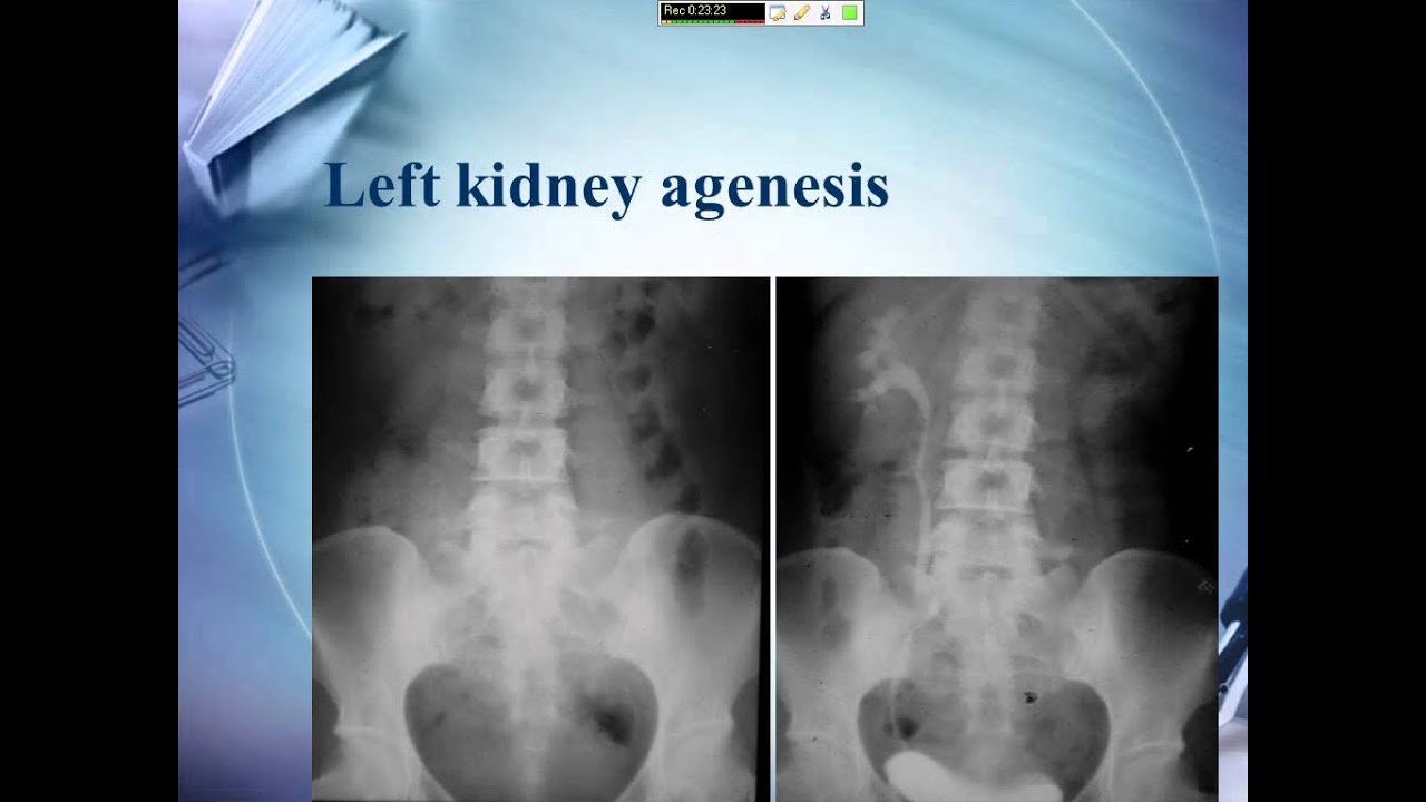 Intravenous Pyelography(IVP) - YouTube