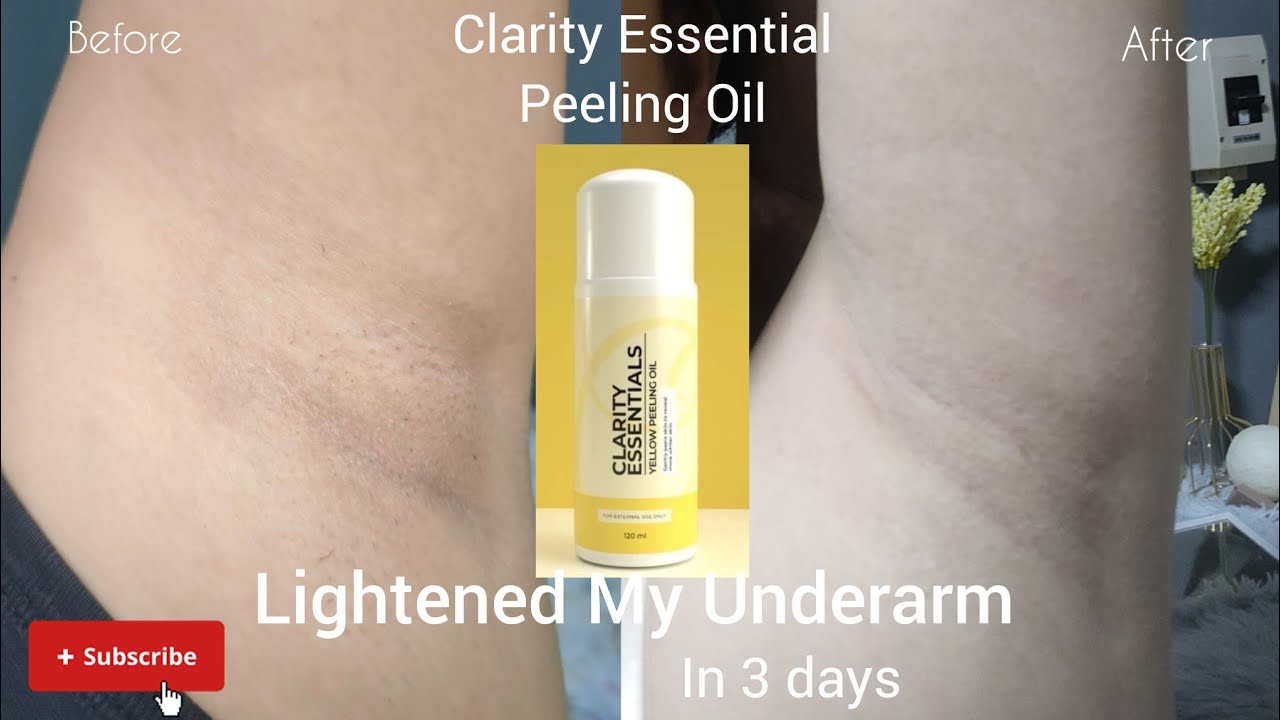 Lightens My Underarm in 3 days(Using Clarity Essential Peeling oil) Effective nga ba? - YouTube