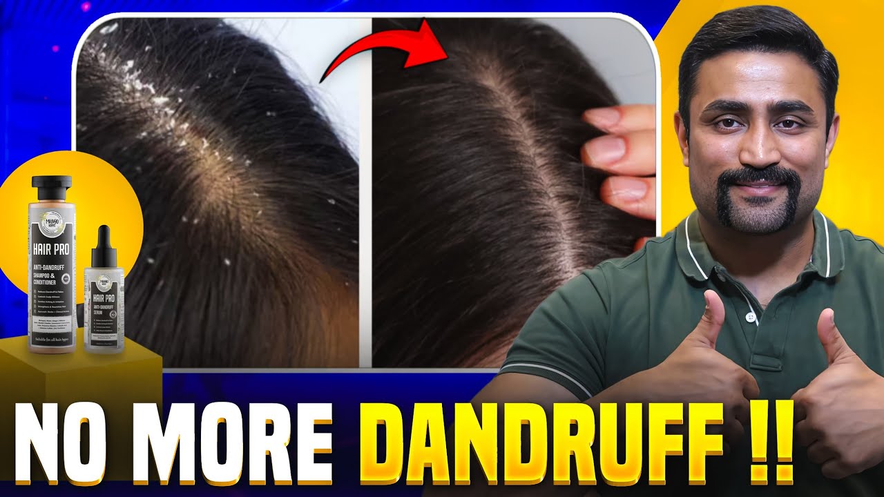 Truth about Dandruff - Causes & Cures !! - YouTube