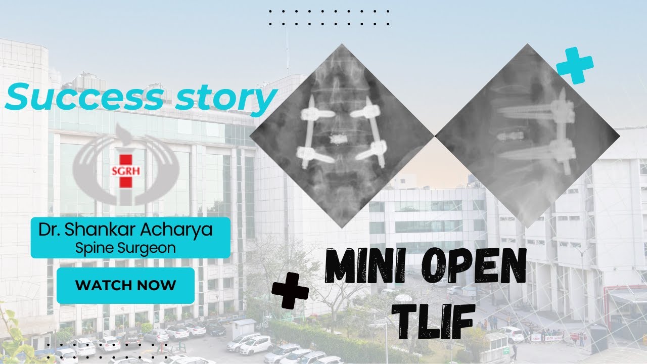 From Pain to Relief: Lumbar Canal Stenosis Treated with Mini Open TLIF ...