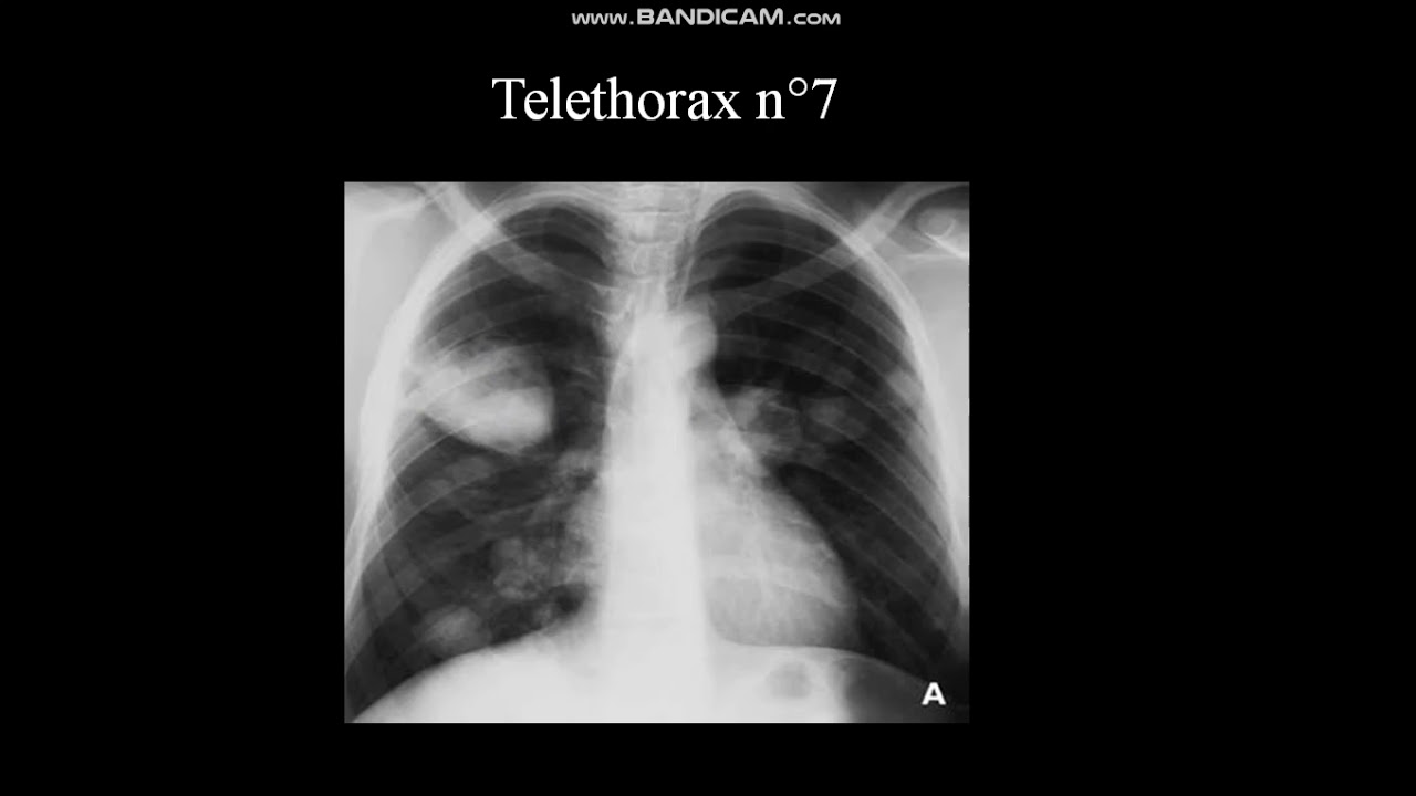interprétation RX type [lâcher de ballon] - YouTube