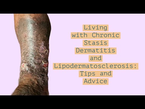 Living with Chronic Stasis Dermatitis and Lipodermatosclerosis: Tips ...