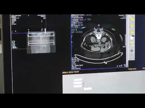 kidney mass biopsy CT guided - YouTube