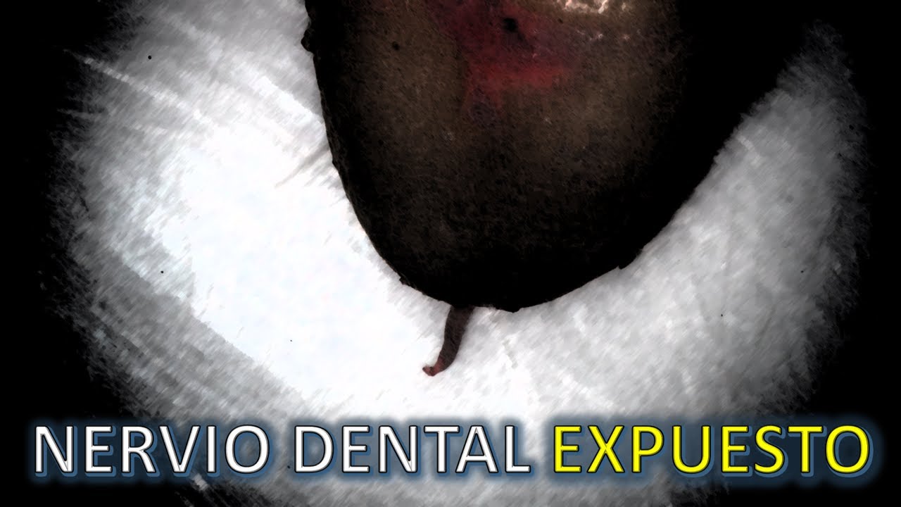 Exposición nervio dental #dentalnerve #nerviodental #toothpulp - YouTube