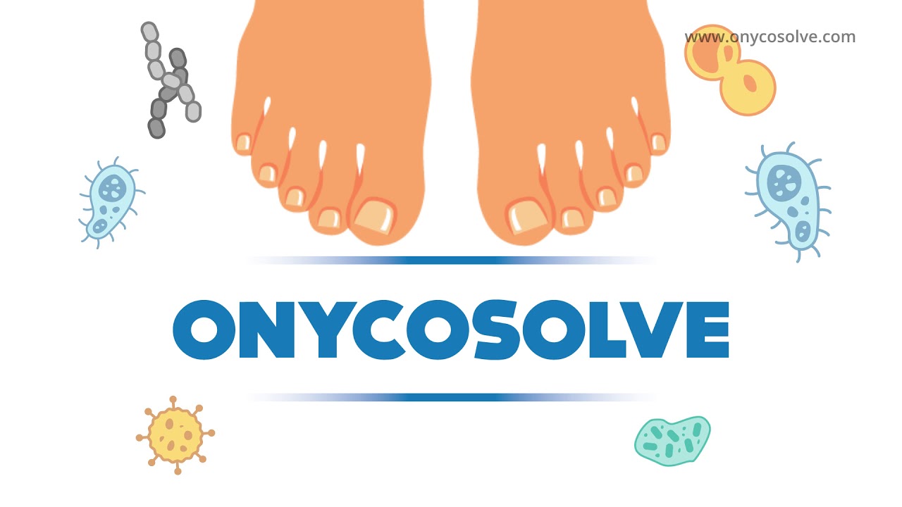 OnycoSolve - A Powerful Weapon Against Feet Fungus - YouTube