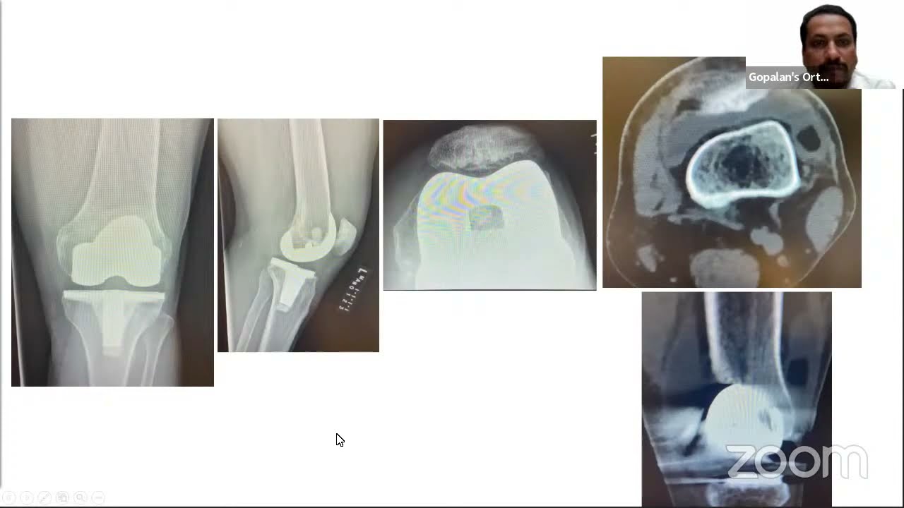 "Know your Plastic" in Knee Replacement - YouTube