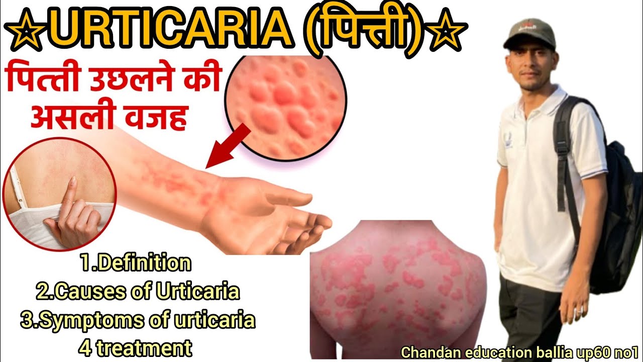 ☆#URTICARIA (पित्ती) ☆Definition. causes .symptoms. treatment. #DOCTOR ...