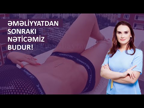 Bədən şəkilləndirmə sonrası passientimizin Bədən görüntüsü | Op. Dr. Gunel Bayramli