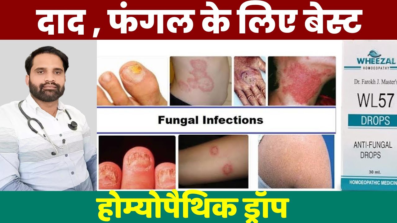 Wheezal Wl 57 drops anti fungal drops - YouTube