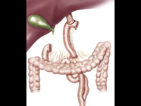 Laparoscopic Total Gastrectomy - YouTube