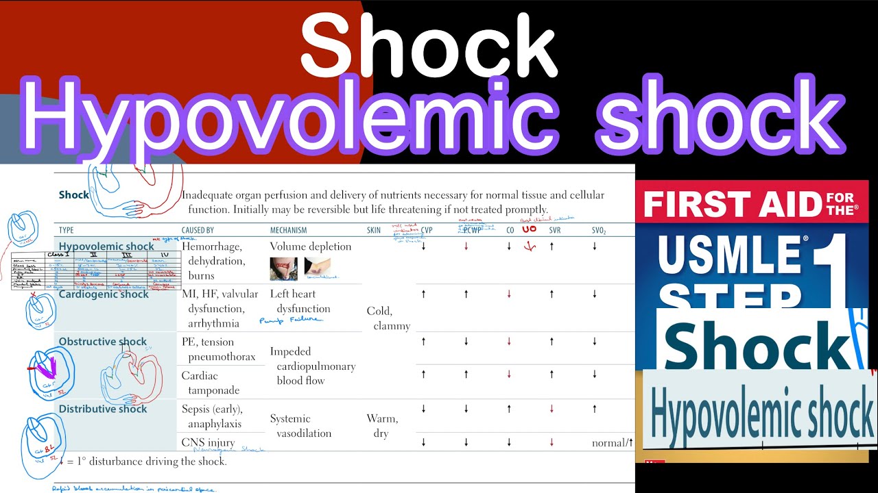 Shock- Hypovolemic shock in Hindi/Urdu by first aid for USMLE step 1 ...