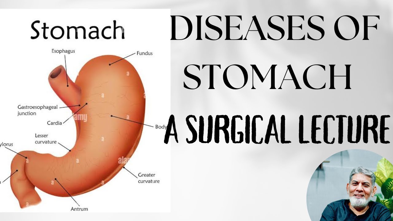 Diseases of stomach: A surgical lecture: | English | | Prof Dr Javed ...
