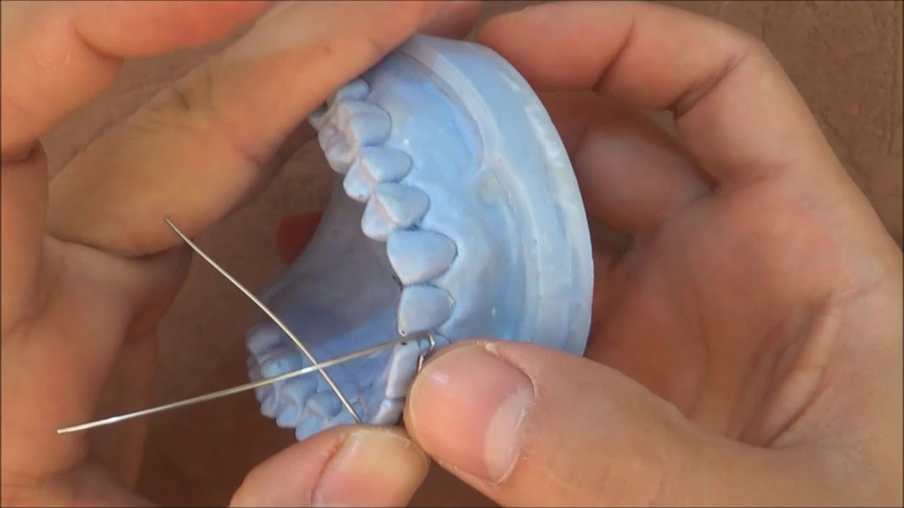 fitted labial arch 2 - YouTube