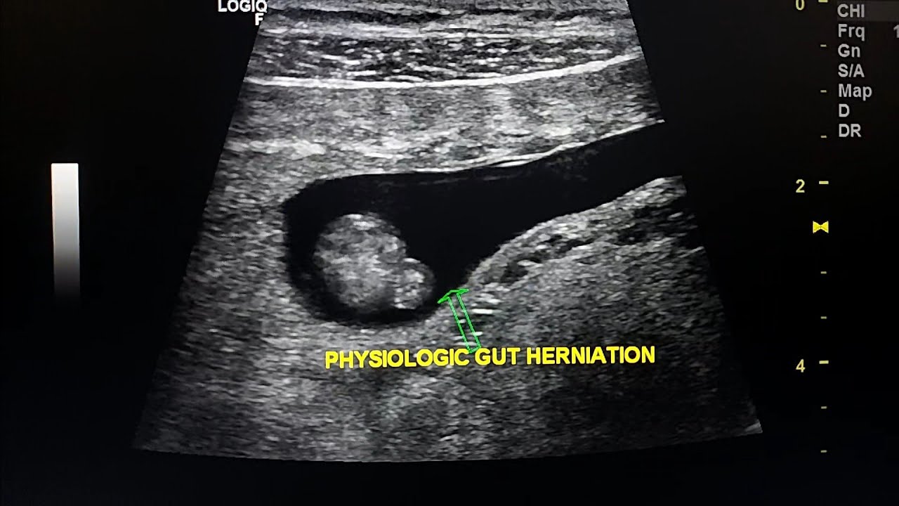 Physiological gut herniation in first trimester ultrasound - YouTube