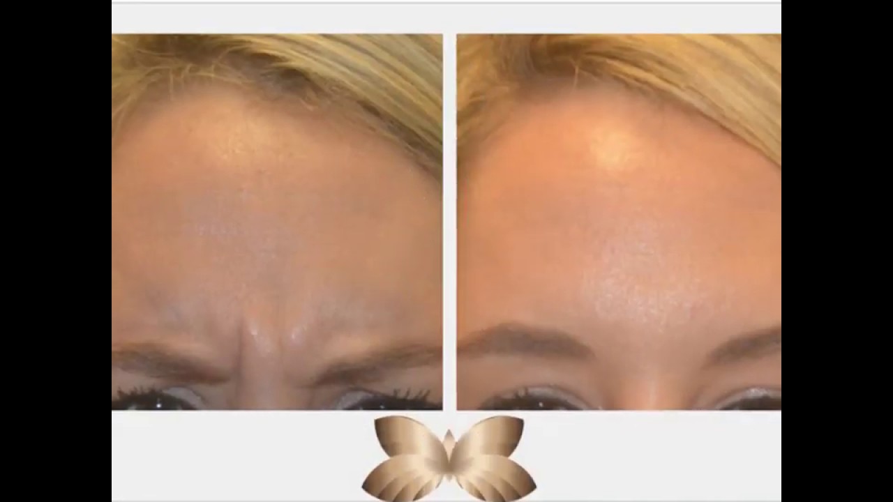 Botox with Jeanna - YouTube