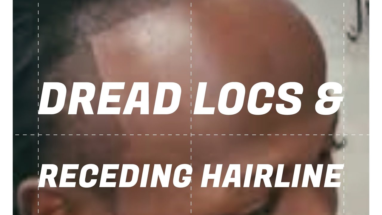 DREADLOCK JOURNEY RECEDING HAIRLINES - YouTube