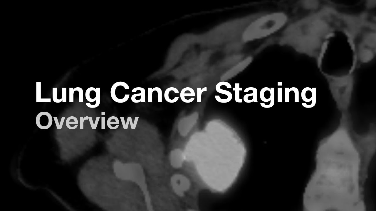 Lung Cancer Staging (Introduction) - YouTube