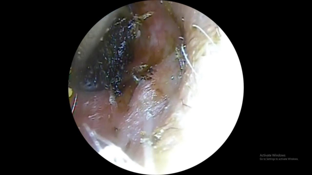 Horror: Cleaning Dry, Deep, Infected Ear Wax 19 - YouTube