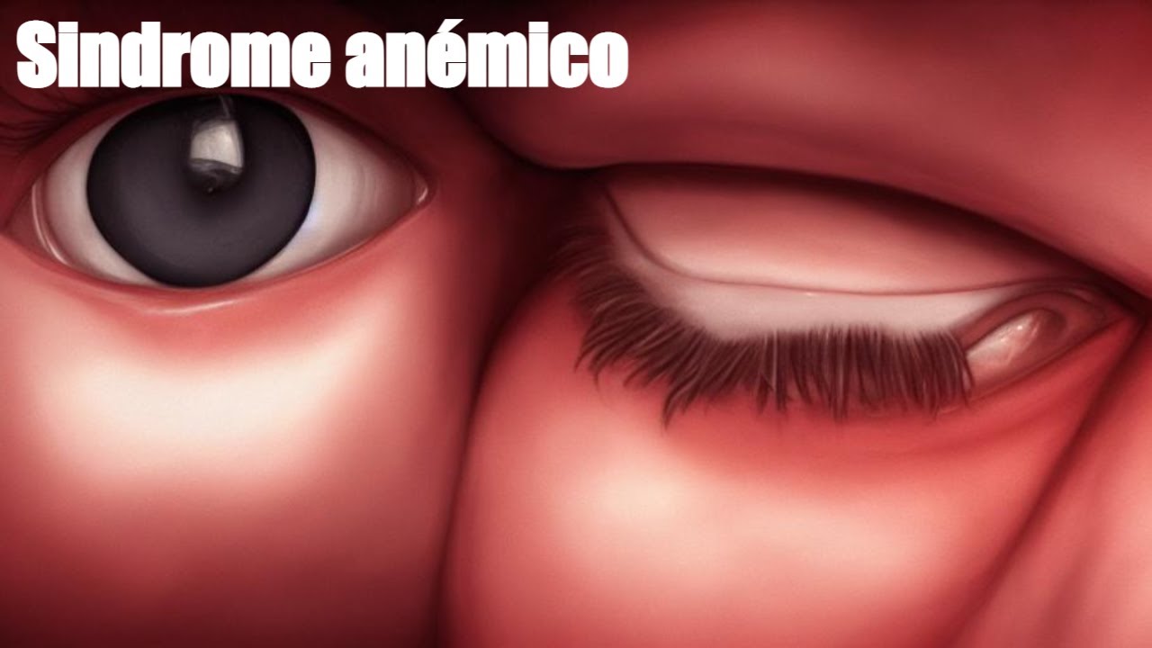 sindrome anémico. Descubrirás el Secreto de la Anemia. #anemias #anemia ...
