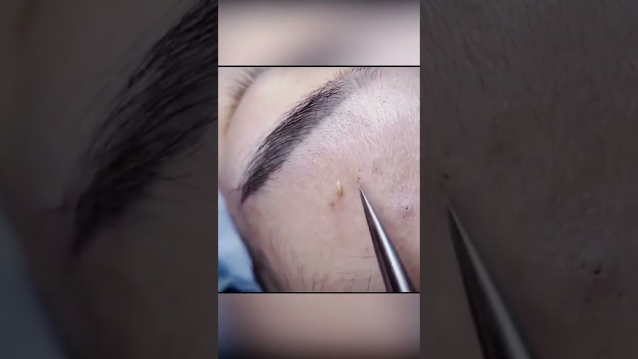 Best Satifying videos for Relaxation with Rat Tana Acne Spa =Short - YouTube