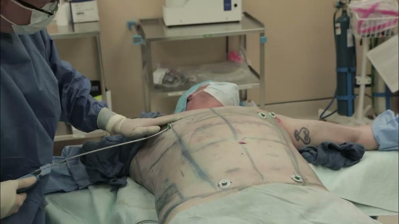 GYNCOMASTIA SURGERY LEBO GYNO & BEYOND TEXAS MALE (40) HI-DEF VASER, LIPO "6 PACK ABS",RENUVION ...