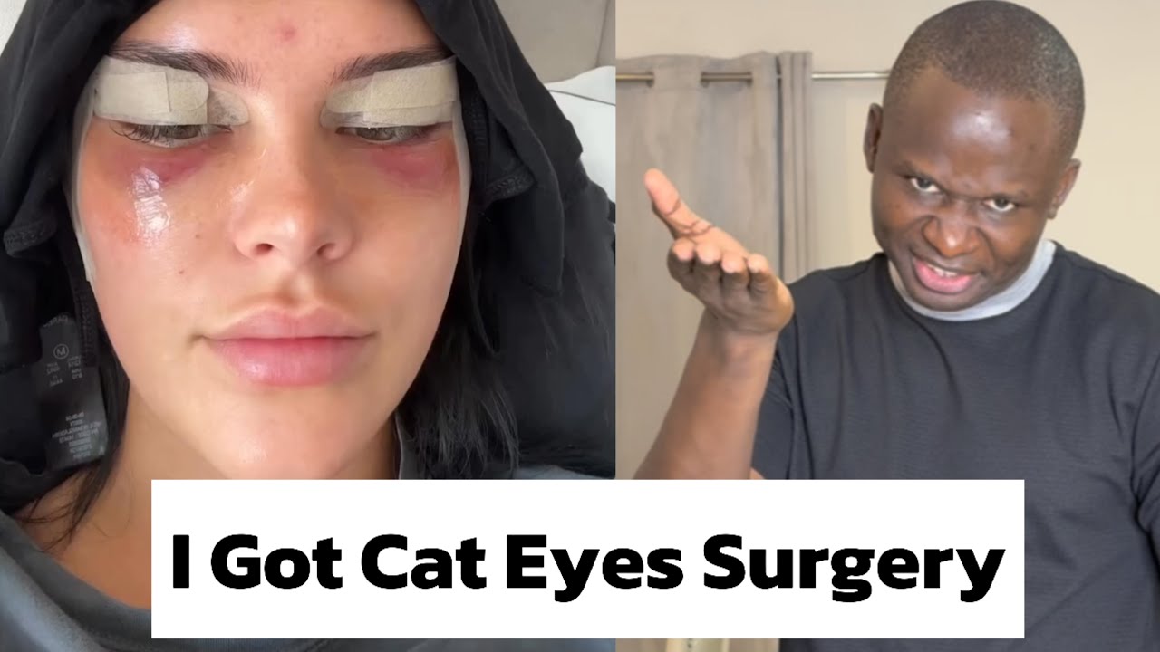 I Got Cat Eye Surgery - YouTube