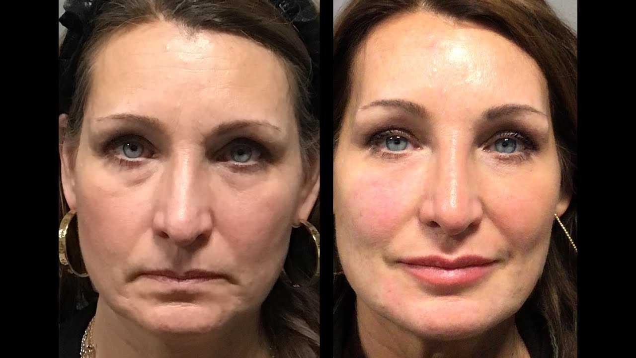 Facial Optimization at Face Forward - YouTube