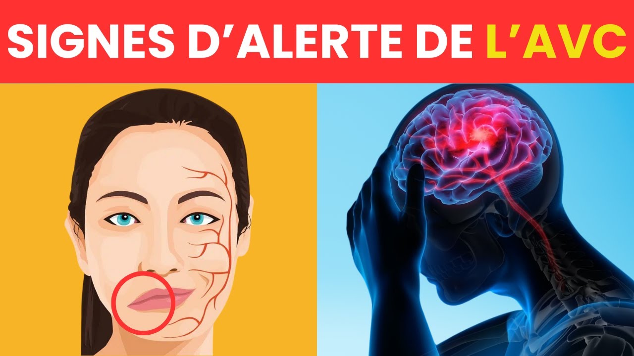 5 signes d'alerte de l'accident vasculaire cérébral | AVC hémorragique ...