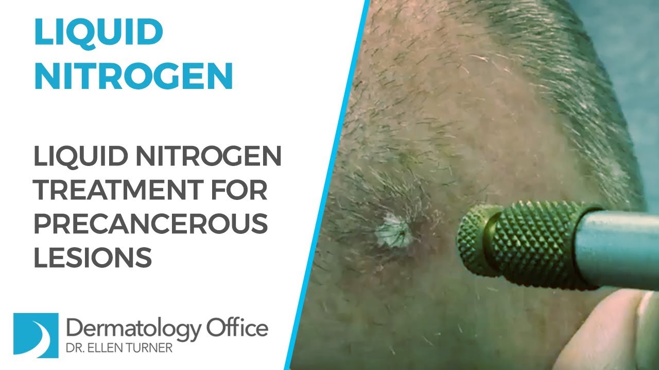 Liquid nitrogen for precancer - YouTube