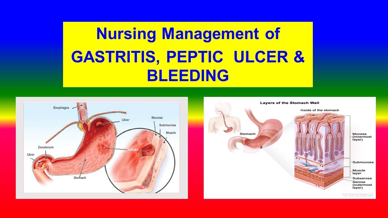 GASTRITIS , PEPTIC ULCER & BLEEDING - Medical Surgical Nursing - YouTube