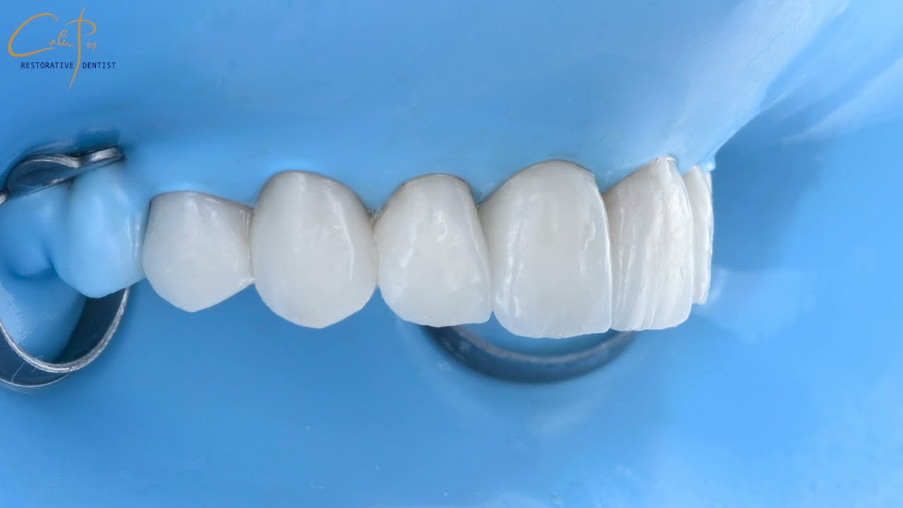 UPPER CERAMIC CROWNS DELIVERED WITH RUBBER DAM - YouTube