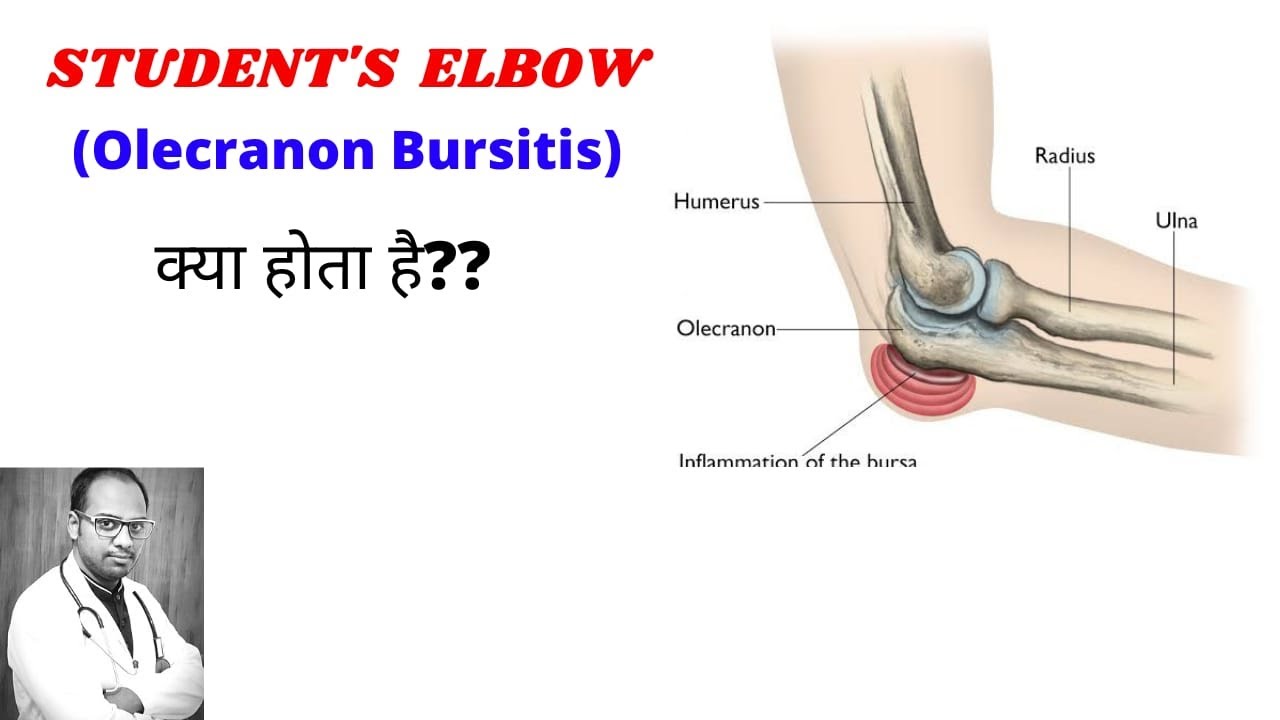 Student's Elbow ( Olecranon Bursitis) - Pathology &Management - YouTube