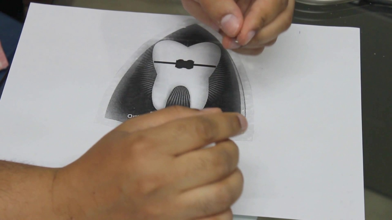 ballista loop , palatally impacted tooth - YouTube