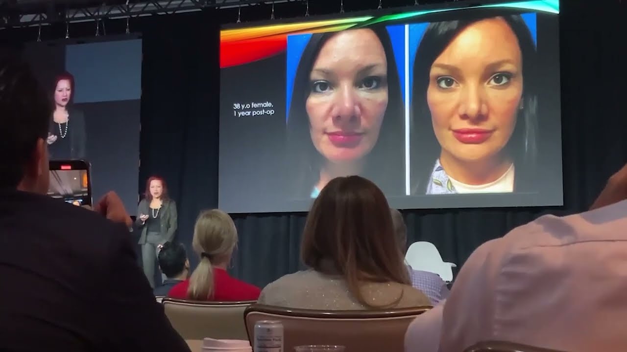 Minimally Invasive Brow Lift with Renuvion at the Renuvion Users ...