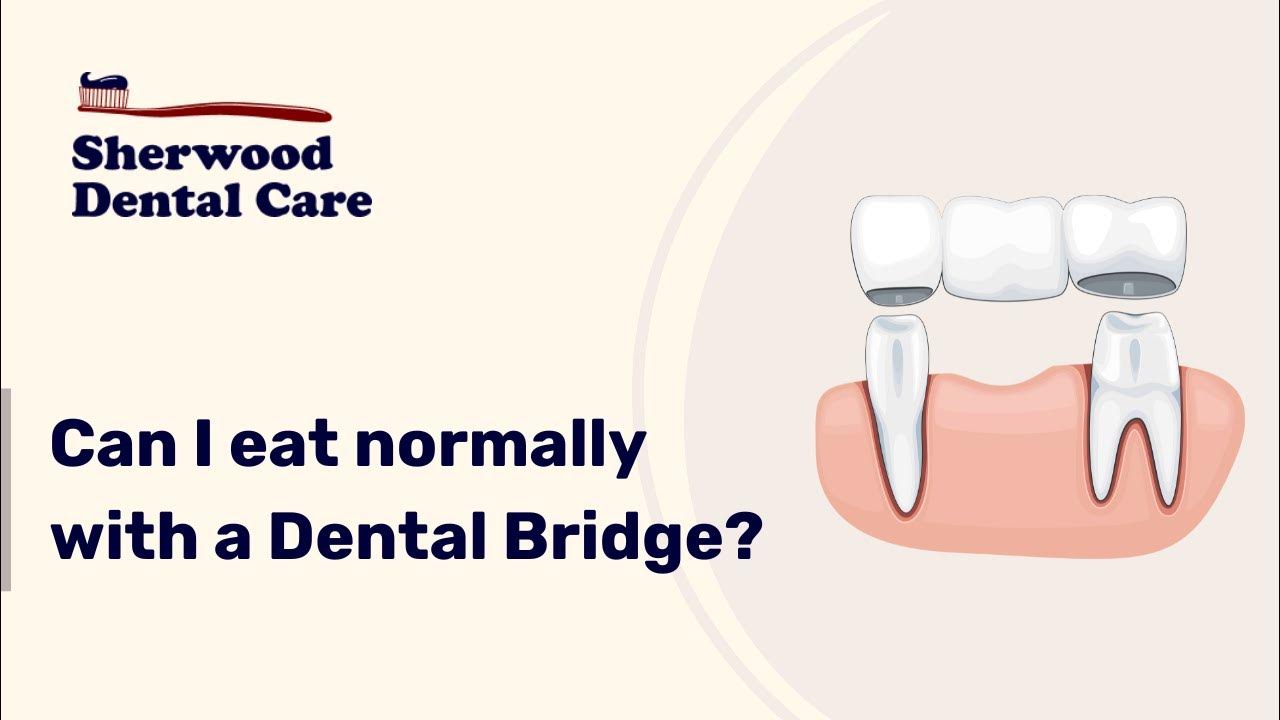 Sherwood Dental Care - Can I eat normally with a Dental Bridge? - YouTube