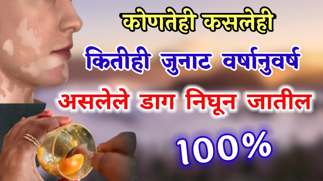 कितीही जुनाट वर्षानुवर्ष असलेले डाग निघून जातील ! pandhare dag upchar ...
