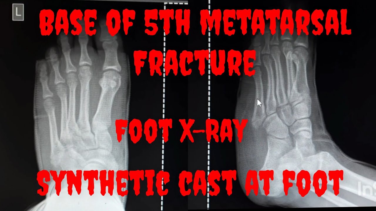Foot X-Ray AP and Oblique view || Synthetic cast done for fracture at ...