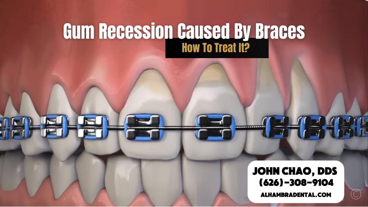 Gum Recession Is a Common Side Effect of Braces? How To Treat It? 🦷 # ...