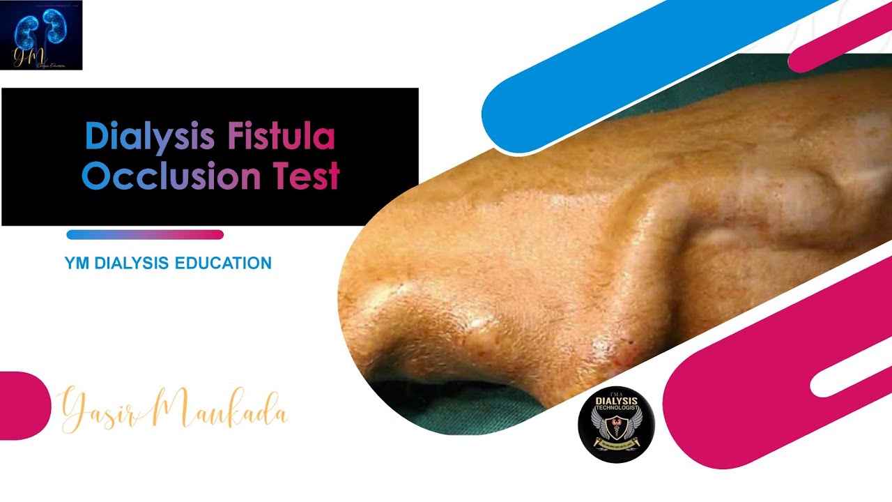 Dialysis Fistula Occlusion Test: How to check Maximum blood flow - YouTube