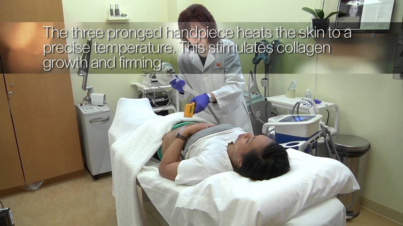 Tripollar Apollo - YouTube